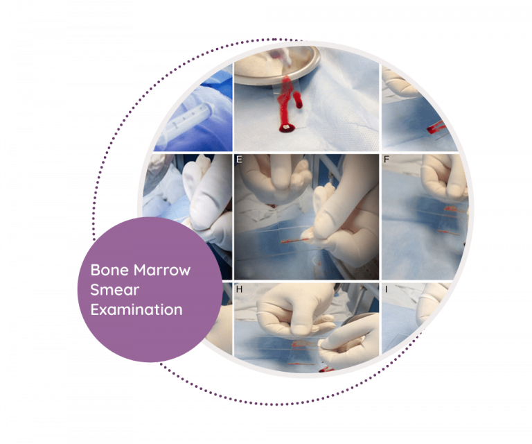 Bone Marrow Smear Examination - MediScan Lab