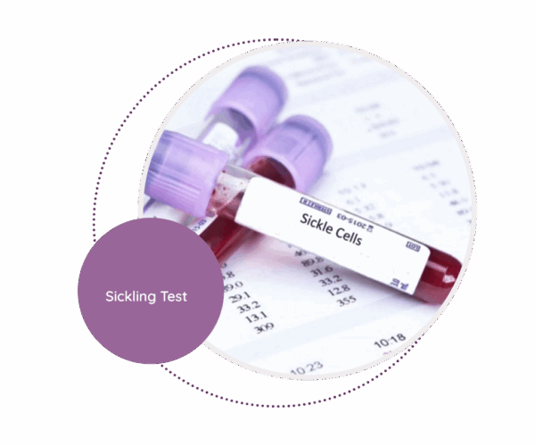 Sickling Test - MediScan Lab